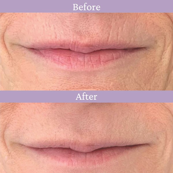Ageless Lip & Line Filler - Prai Beauty UK